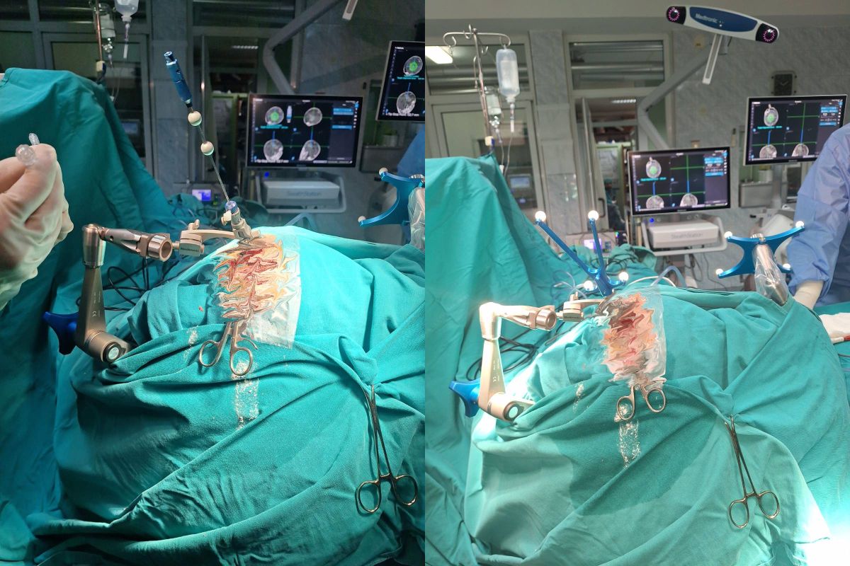 Historijski iskorak u Kantonalnoj Bolnici Zenica: Uspješno izvedena ...